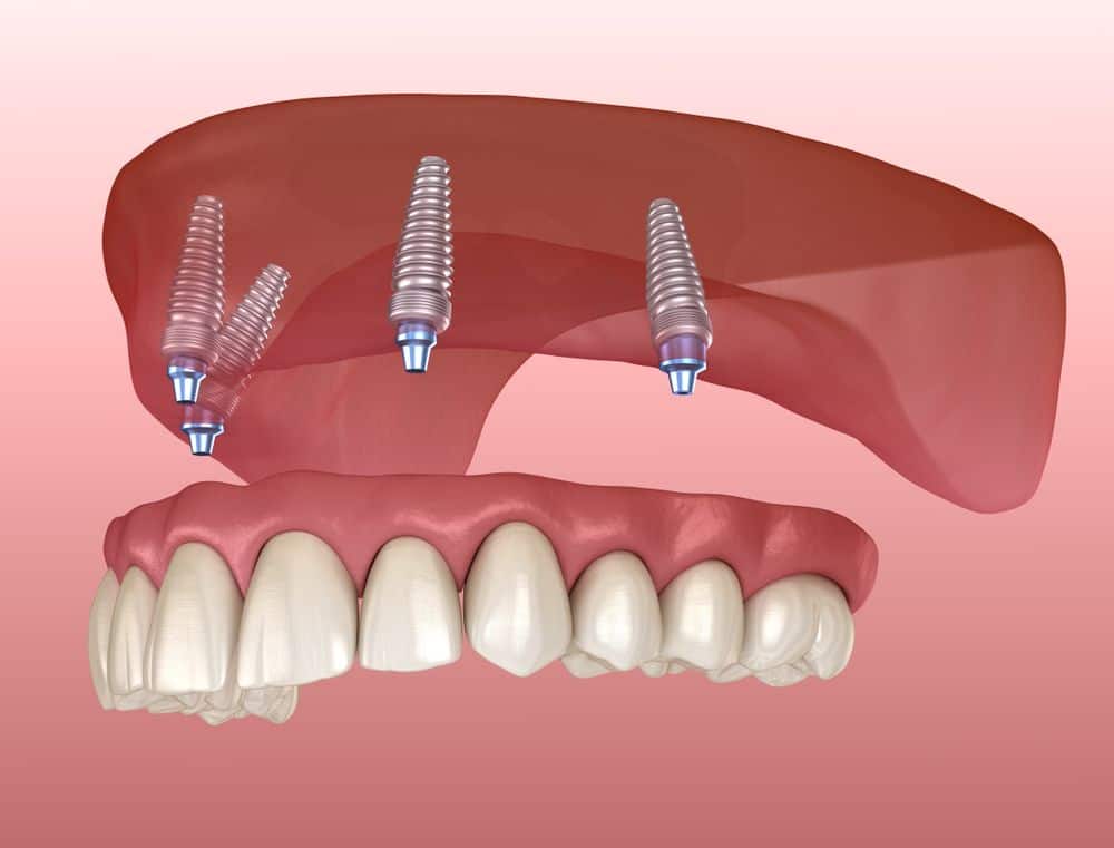 All on Four Implants | Snap In Dentures | Memphis